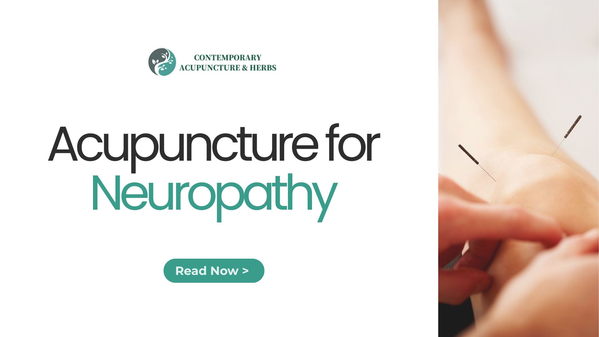 Acupuncture for Neuropathy: Evidence-Based Guide to Relief ...
